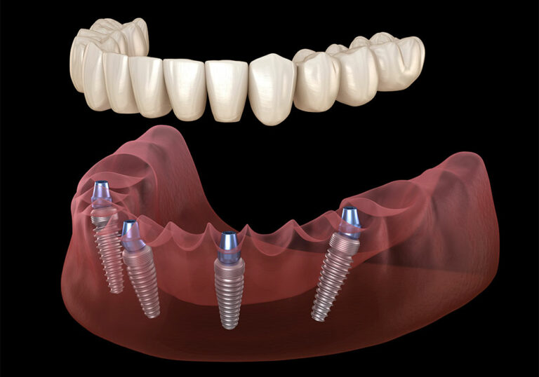 Tooth Replacement Options Houston | Full Teeth Replacement